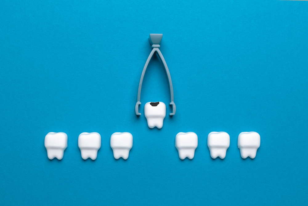Everything You Need to Know about Tooth Extractions